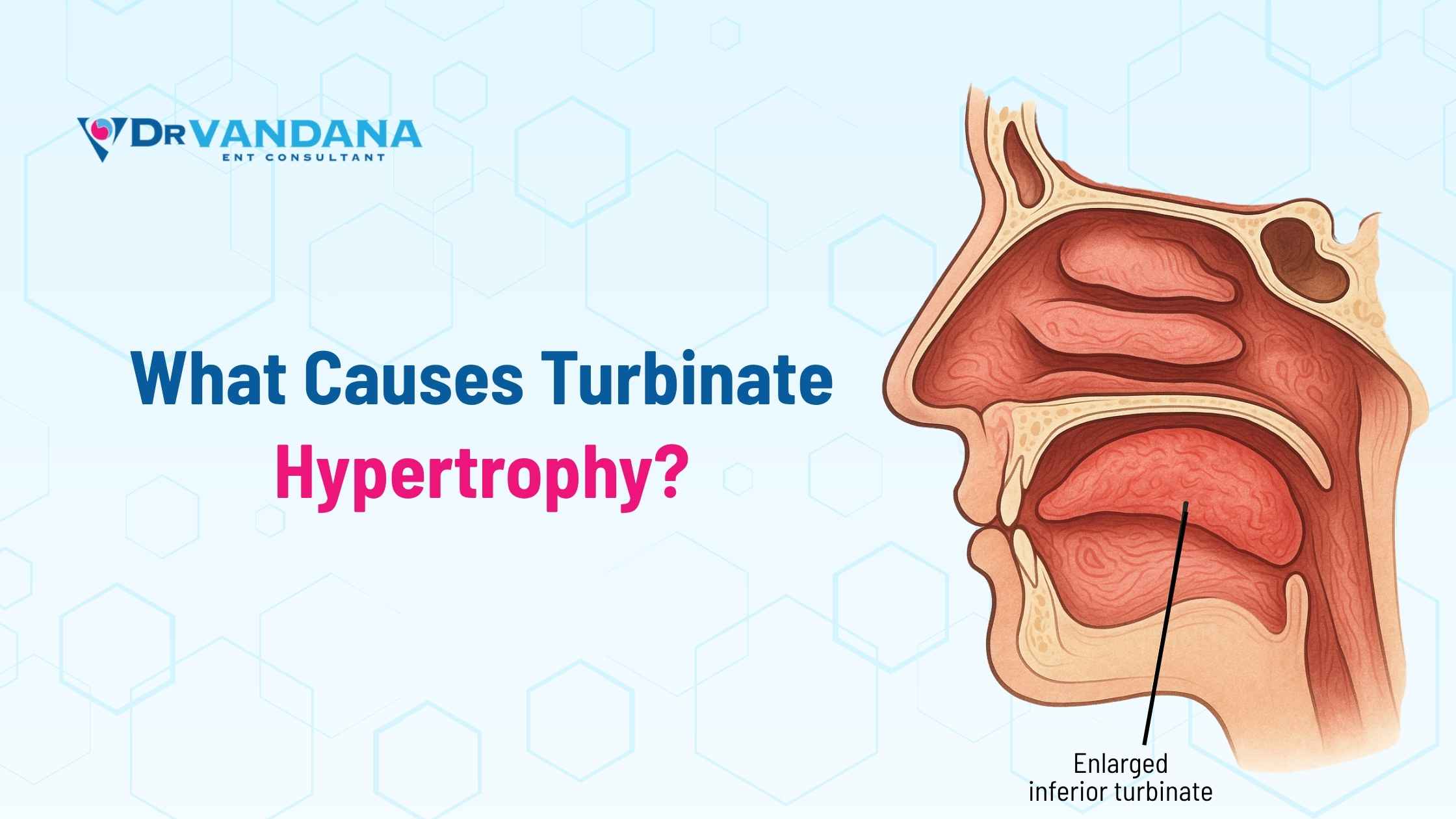 Causes of Turbinate Hypertrophy